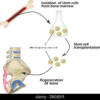 Stammzellen aus dem Knochenmark werden für die Knochenregeneration ...