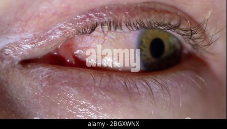 Entzündete Augeninfektion. Rote blutige Augen Nahaufnahme Makro ...