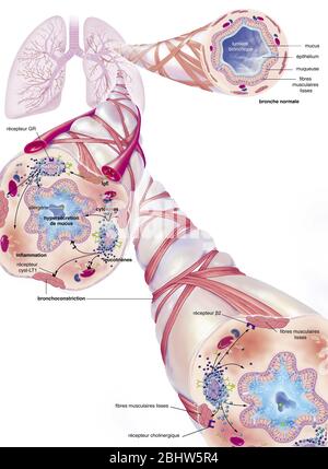 Asthma und seine Behandlungen. Darstellung der Lunge mit dem ...