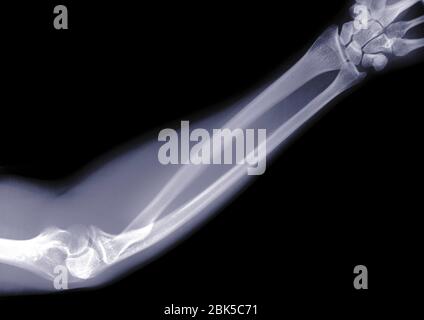 Röntgenblick der Ellenbogen Knochen in einem durchsichtigen Arm mit ...
