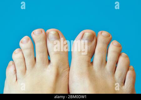 Fuß mit Nagel psoriasis. Eine Frau hat einen eingewachsenen Zehennagel ...