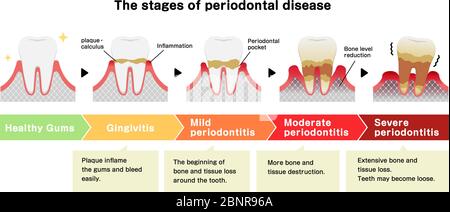 Die Stadien der Parodontitis Krankheit Vektor Illustration Stock ...