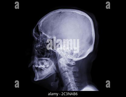 Schlaganfall. Film Röntgen Schädel Seitenansicht zeigen menschliche ...