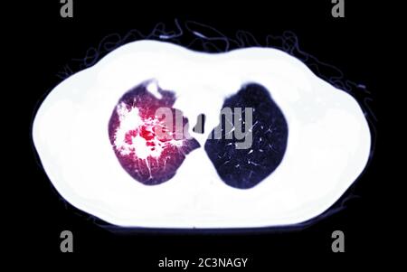 Selektiver Fokus der CT-Ansicht der AXIALEN und koronalen MIP-Ansicht für diagnostische ...