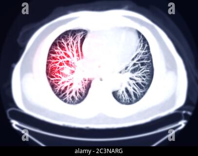 Selektiver Fokus der CT-Ansicht der AXIALEN und koronalen MIP-Ansicht für diagnostische ...