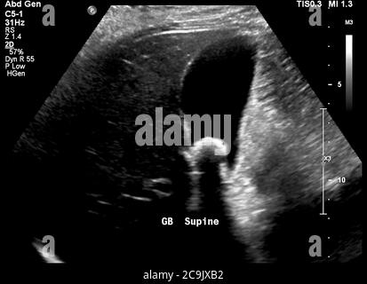 Ein Gallenstein ist ein Stein in die Gallenwege gebildet, bestehend aus ...