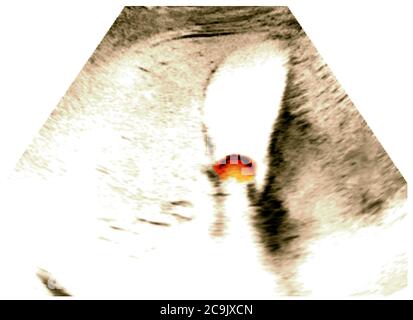 Ein Gallenstein ist ein Stein in die Gallenwege gebildet, bestehend aus ...