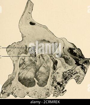 Zahnmedizinische Anatomie - Erste Oberkiefer Backenzahn. Medizinisch ...