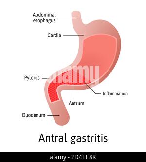 Lage der Gastritis, eine Entzündung der Magenschleimhaut. Drei Typen ...
