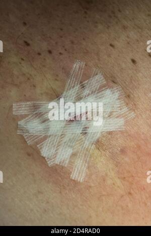 Close-up von Hautkrebs, eine oberflächliche Ausbreitung Melanom (SSM ...