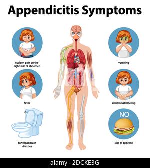 Infografik zur Beschreibung der Symptome von Appendizitis Stock ...