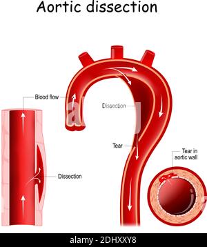 Menschliche Herz Querschnitt anatomische Darstellung mit aorta ...