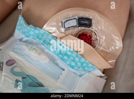 Draufsicht auf Kolostomie Tasche, Lieferungen nach Kolostomie Chirurgie ...