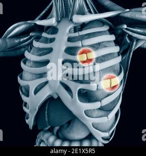 Anatomie und der menschliche Körper. Costochondral Trennung, getrennte ...