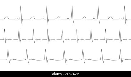 Herz EKG Diagramm Vektor. Gesundes Herz Rhythmus, Ischämie, Infarkt ...