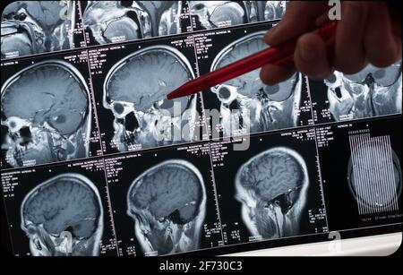 MRT-Untersuchung des menschlichen Gehirns, monochrom Stockfotografie - Alamy