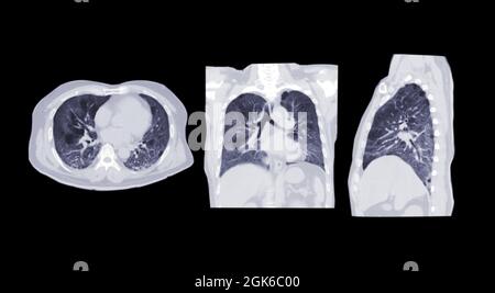 CT-Scan der Thorax- oder Lungenkoronalansicht in der Radiologieabteilung im Krankenhaus. Covid ...