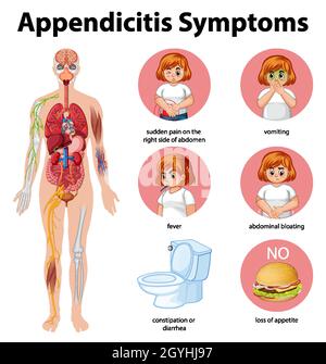 Infografik zur Beschreibung der Symptome von Appendizitis Stock ...
