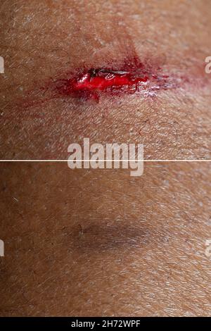 Vor und nach der Behandlung von Verbrühungswunde in der Hand und im ...