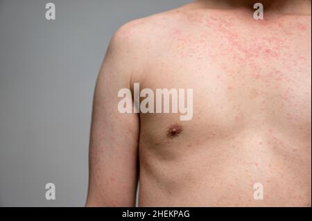 Dermatitis Hautausschlag Viruserkrankung mit Immunschwäche am Körper ...