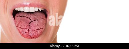 Risse In Der Zunge Stress