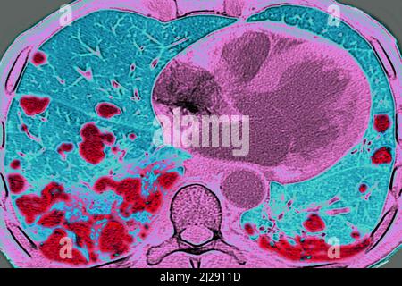 Lungenmetastasen (sekundär zu Nierenkrebs), visualisiert durch Thorax-CT-Scan im axialen Schnitt ...