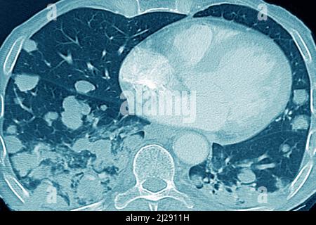 Lungenmetastasen (sekundär zu Nierenkrebs), visualisiert durch Thorax-CT-Scan im axialen Schnitt ...
