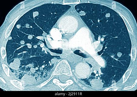 Lungenmetastasen (sekundär zu Nierenkrebs), visualisiert durch Thorax-CT-Scan im axialen Schnitt ...