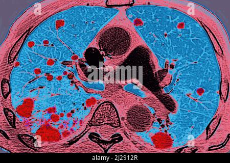 Lungenmetastasen (sekundär zu Nierenkrebs), visualisiert durch Thorax-CT-Scan im axialen Schnitt ...