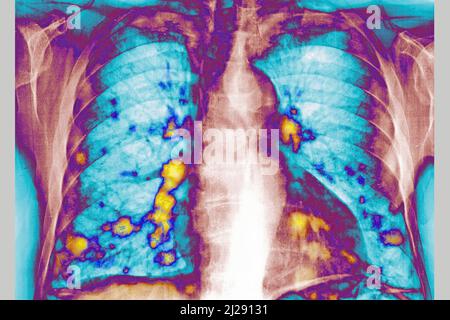 Lungenmetastasen (sekundär zu Nierenkrebs), visualisiert durch Thorax-CT-Scan im axialen Schnitt ...