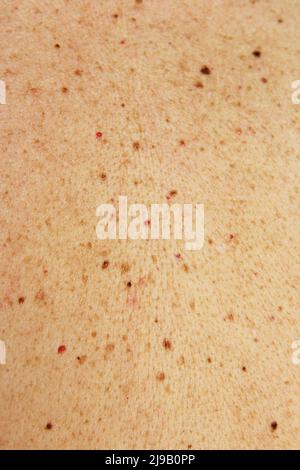 Muttermale und Muttermale auf der menschlichen Hautstruktur. Foto ...