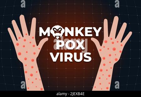 Monkeypox Virus infection on Hand Banner Konzept. Affenpocken-Krankheit ...