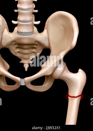 Abbildung zeigt eine Fraktur im Nacken des Oberschenkels (Oberschenkelknochen Stockfotografie ...