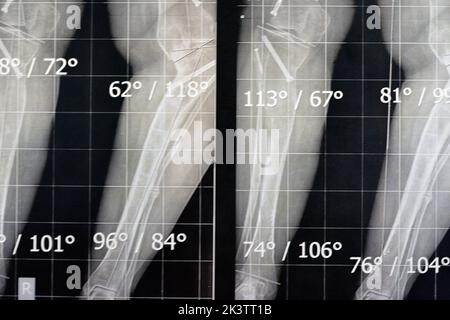 Rachitis Femur Tibia Stockfotografie - Alamy
