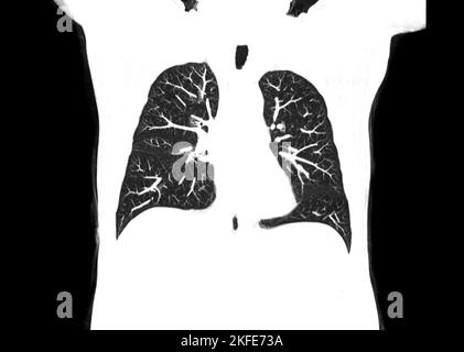 CT-Scan der Thorax- oder Lungenkoronalansicht in der Radiologieabteilung im Krankenhaus. Covid ...