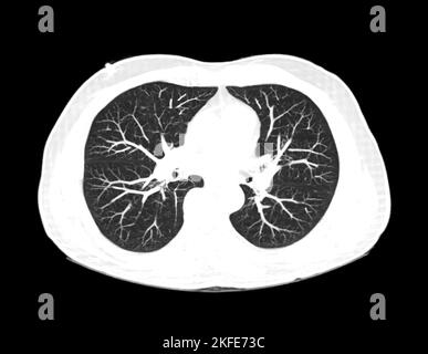 Lungenembolie, CT SCAN Stockfotografie - Alamy
