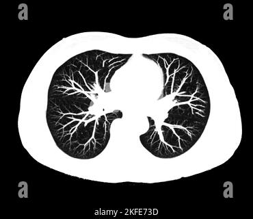 Lungenembolie, CT SCAN Stockfotografie - Alamy