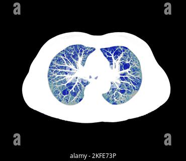 Lungenembolie, CT SCAN Stockfotografie - Alamy