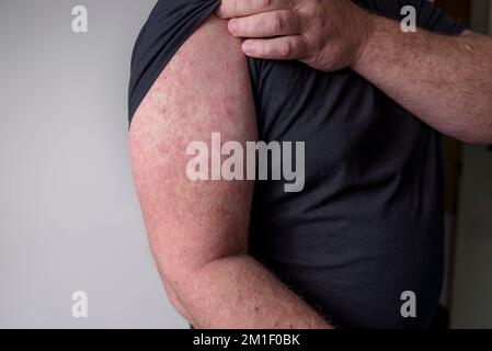 Erysipel - Nahaufnahme an der Hand. Am Unterarm erscheint ein roter ...