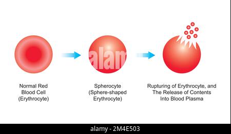 Wissenschaftliches Design der Hämolyse. Die Zerstörung roter ...