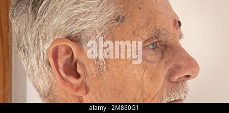 Keratoakanthom-Hautkrebswachstum auf einer männlichen Stirn ...