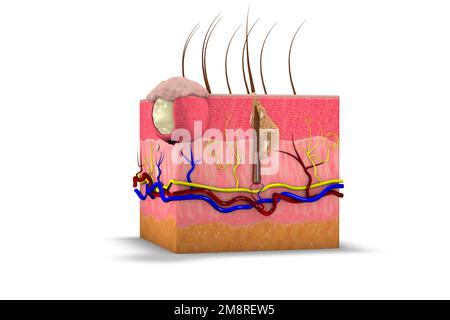 Hautabschnitt mit Zyste, subkutane Schwellung. Pilarzyste und Talgzyste ...