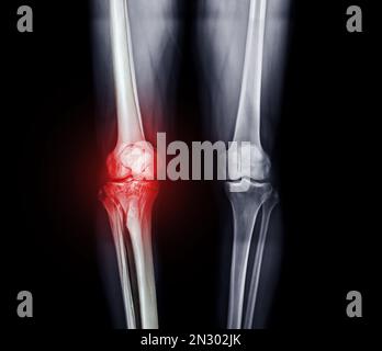 Röntgenbild beider Patellafrakturen zur diagnostischen Patellafraktur oder Patellaluxation ...