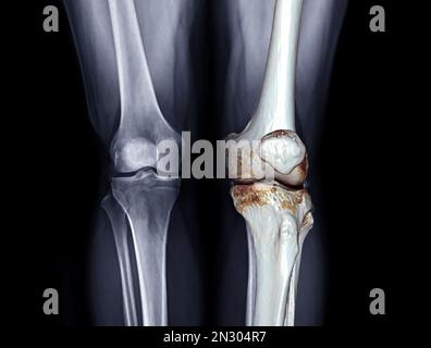 Röntgenbild beider Patellafrakturen zur diagnostischen Patellafraktur oder Patellaluxation ...