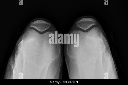 Röntgenbild beider Patellafrakturen zur diagnostischen Patellafraktur oder Patellaluxation ...