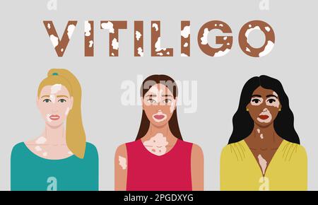 Set von weiblichen Gesichtern mit Vitiligo. Poster zum Welt-Vitiligo-Tag. Sammlung von Porträts ...
