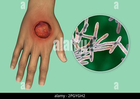 Buruli-Ulkus und Mycobacterium ulcerans, Illustration Stockfotografie ...