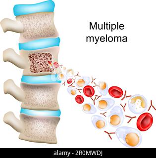 MULTIPLES MYELOM, KNOCHENMARK Stockfotografie - Alamy
