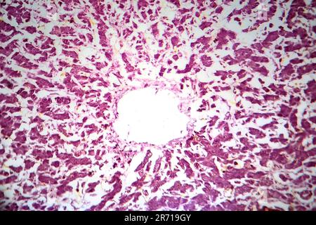 Histopathologie der akuten schweren Hepatitis, Lichtmikrographen ...