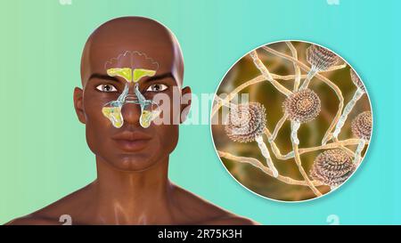 Aspergillus fungi als Ursache einer Sinusitis. Computerdarstellung mit ...